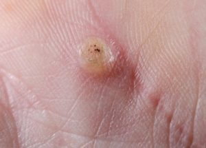 Comment se débarrasser d’une verrue ? - Pratique.ch