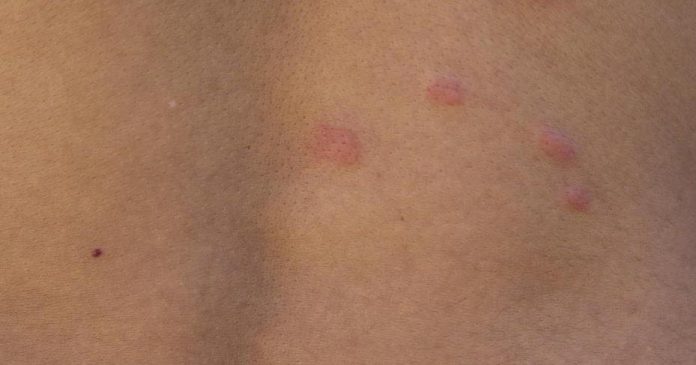 Puces de sable : Comment éviter et soigner les piqûres - Pratique.ch